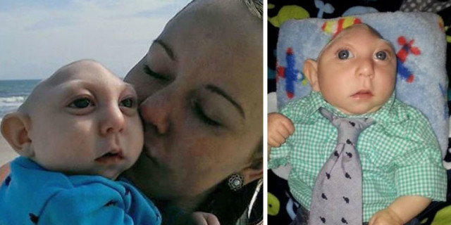 Jaxon, un bebé con anencefalia (ausencia de cráneo y cerebro) conmueve ...